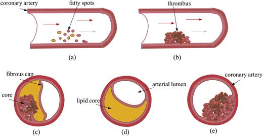 Numerical study on biomechanics in bifurcated coronary artery with plaques of different ...
