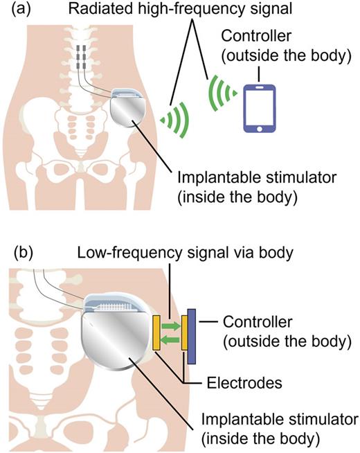 Signal transmission analysis in implantable human body communication ...
