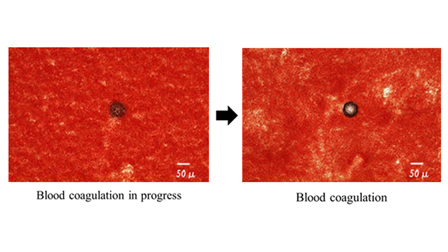 Detection of blood coagulation in an extracorporeal circuit using ...
