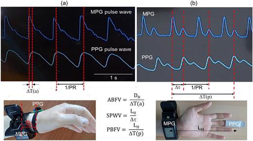 Characteristics of blood flow velocity in the radial artery and finger ...
