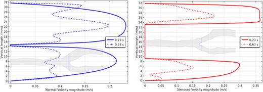 Unveiling hemodynamic pulsatile flow dynamics in carotid artery ...