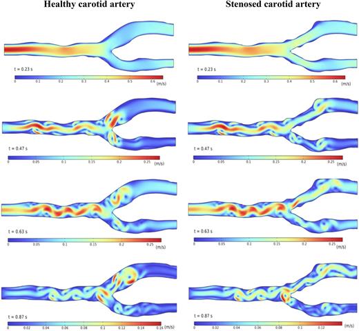 Unveiling hemodynamic pulsatile flow dynamics in carotid artery ...