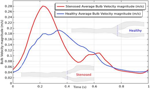 Unveiling hemodynamic pulsatile flow dynamics in carotid artery ...