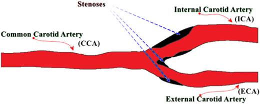 Unveiling hemodynamic pulsatile flow dynamics in carotid artery stenosis: Insights from ...