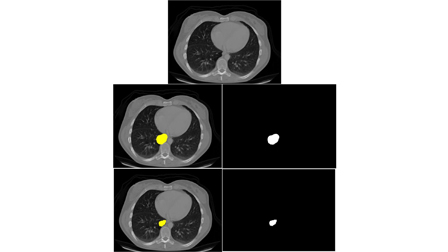Segmentation of lung nodules in CT images using weighted average based ...