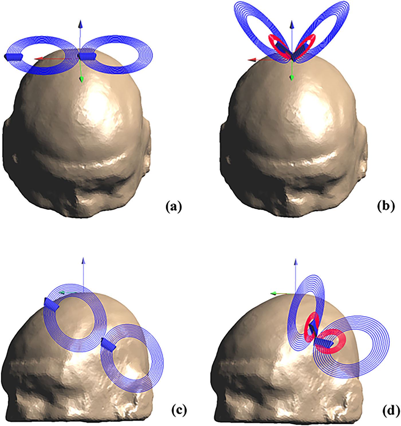 Transcranial Magnetic Stimulation-coil design with improved focality ...