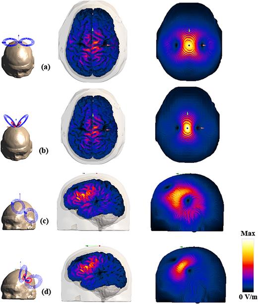 Transcranial Magnetic Stimulation-coil design with improved focality ...