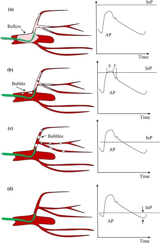 Carbon dioxide coronary angiography: A mechanical feasibility study ...