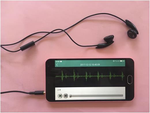 Design of a high SNR electronic heart sound sensor based on a MEMS ...
