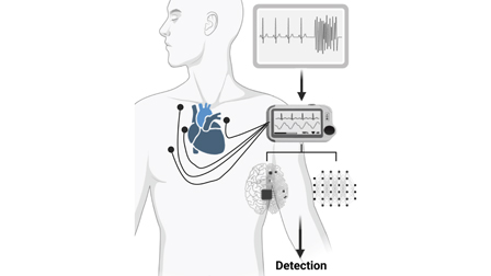 On-device edge-learning for cardiac abnormality detection using a bio ...