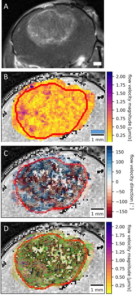 MRI analysis to map interstitial flow in the brain tumor ...