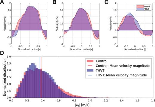 Altered blood flow due to larger aortic diameters in patients with ...