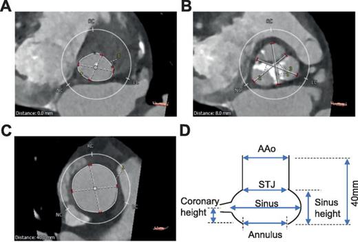 Altered blood flow due to larger aortic diameters in patients with ...
