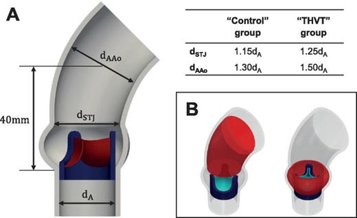 Altered blood flow due to larger aortic diameters in patients with ...