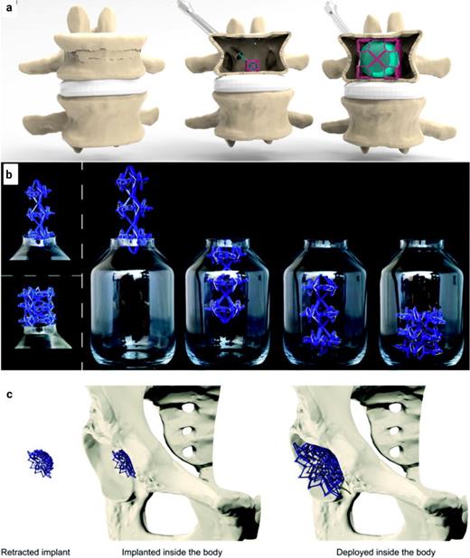 Orthopedic meta-implants | APL Bioengineering | AIP Publishing