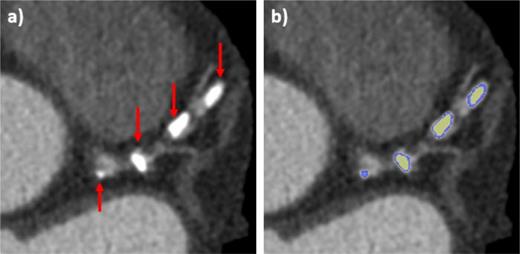A fully automated deep learning approach for coronary artery ...
