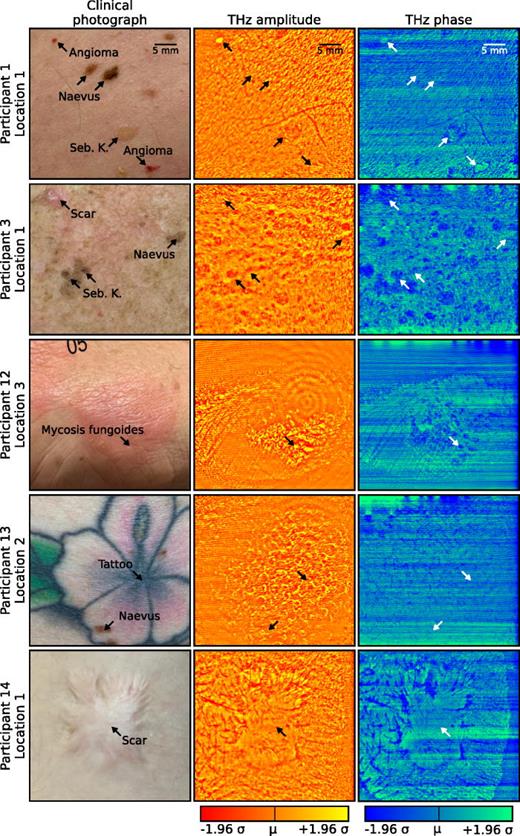 Terahertz in vivo imaging of human skin: Toward detection of abnormal ...