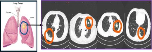An optimized convolutional neural network architecture for lung cancer ...
