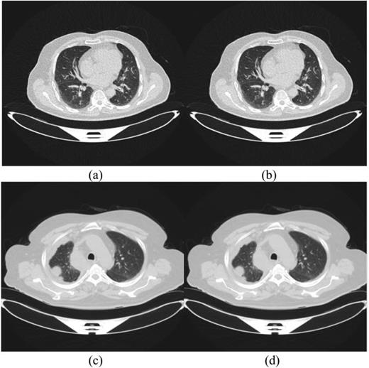 An optimized convolutional neural network architecture for lung cancer ...