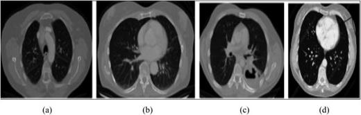 An optimized convolutional neural network architecture for lung cancer ...