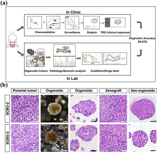 Exploring tumor organoids for cancer treatment | APL Materials | AIP ...