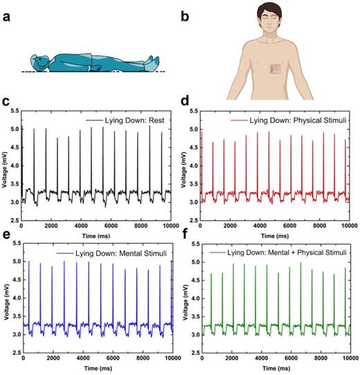 Dry electrode geometry optimization for wearable ECG devices | Applied ...