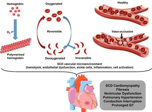 Cardiovascular consequences of sickle cell disease | Biophysics Reviews ...