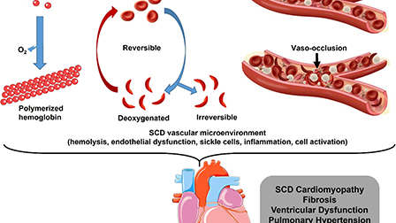 Cardiovascular consequences of sickle cell disease | Biophysics Reviews ...