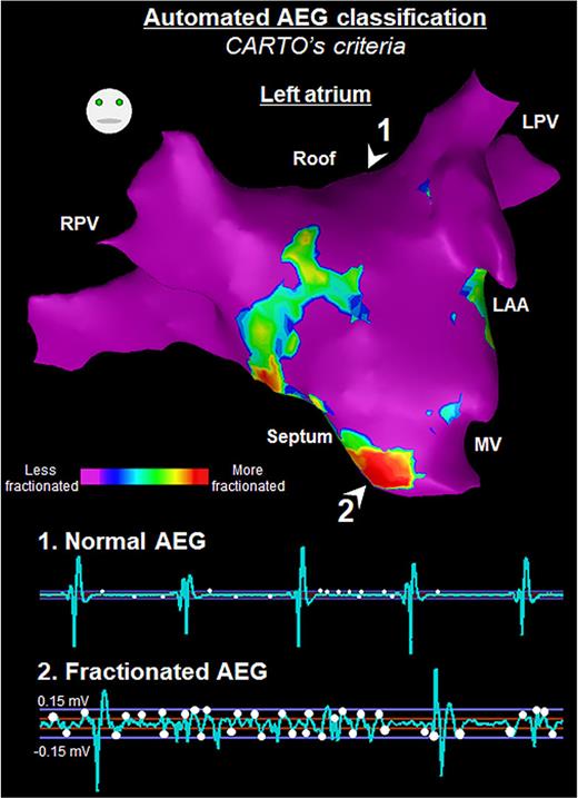 Characterization of human persistent atrial fibrillation electrograms ...
