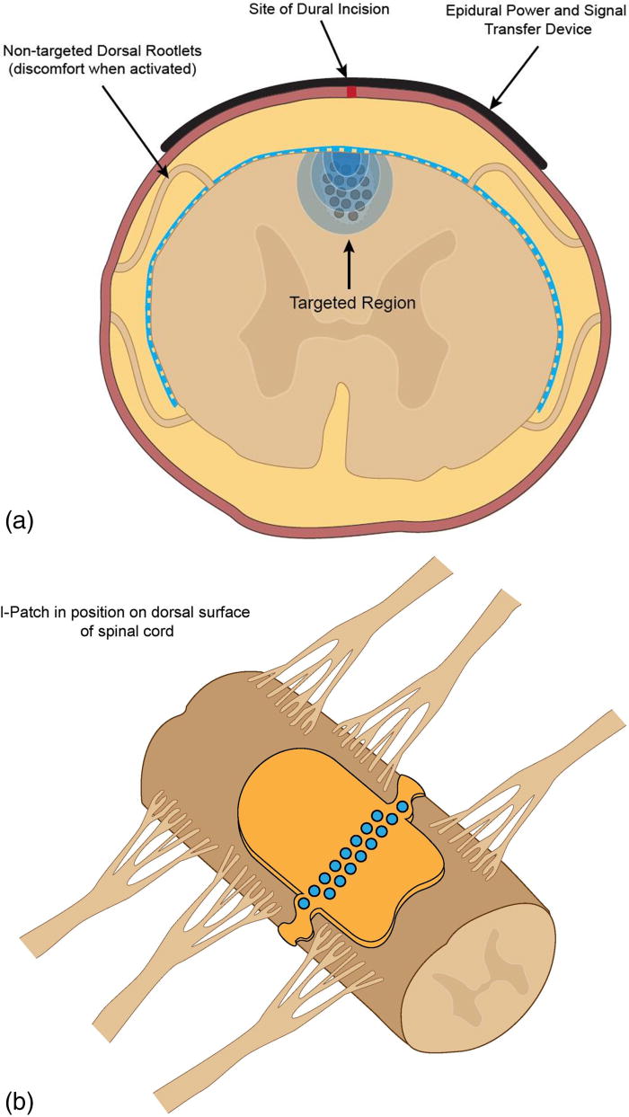 Intradural approach to selective stimulation in the spinal cord for ...