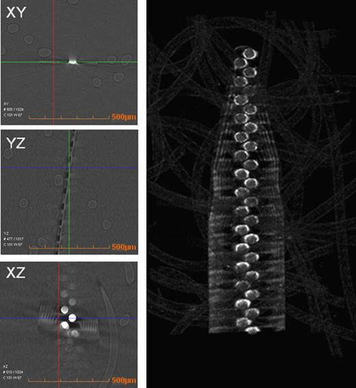 Enhanced x-ray imaging for a thin film cochlear implant with metal ...