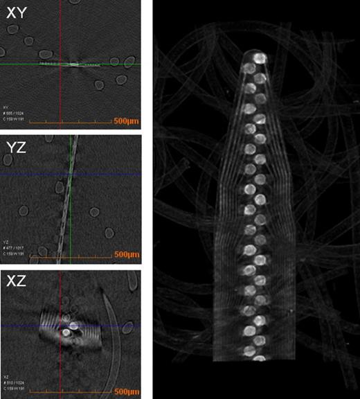 Enhanced x-ray imaging for a thin film cochlear implant with metal artefacts using phase ...