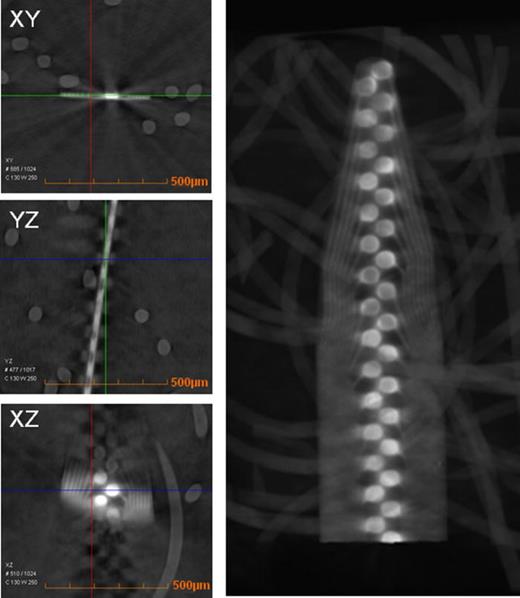 Enhanced x-ray imaging for a thin film cochlear implant with metal ...
