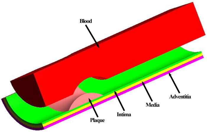Plaque and arterial vulnerability investigation in a three-layer atherosclerotic human coronary ...