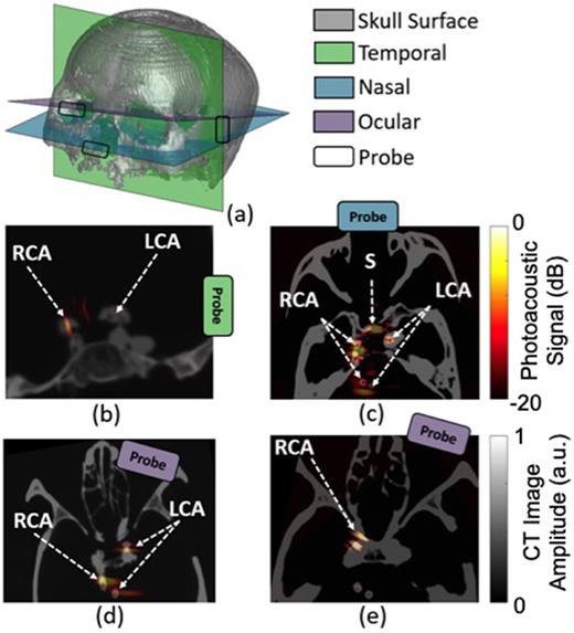 Photoacoustic imaging for surgical guidance: Principles, applications ...