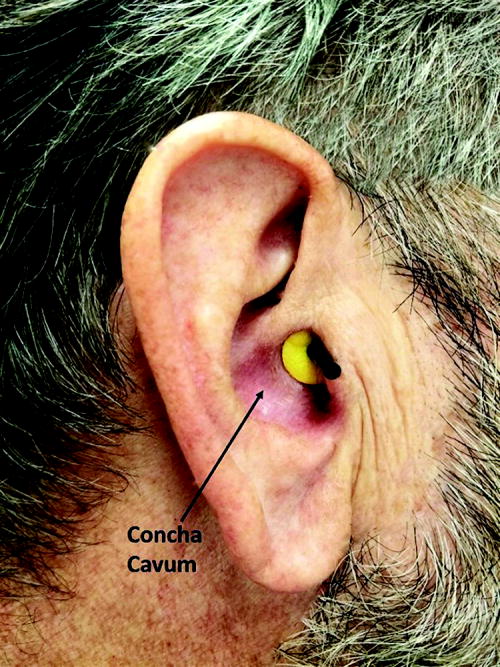Boothless audiometry: Ambient noise considerations | The Journal of the ...