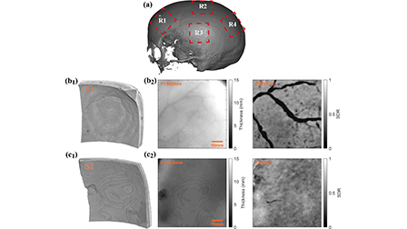 Effects of skull properties on continuous-wave transcranial focused ...