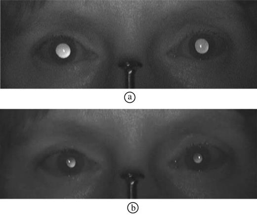 Risk of retinal injury from “Risk Group 2” laser illuminated projectors ...