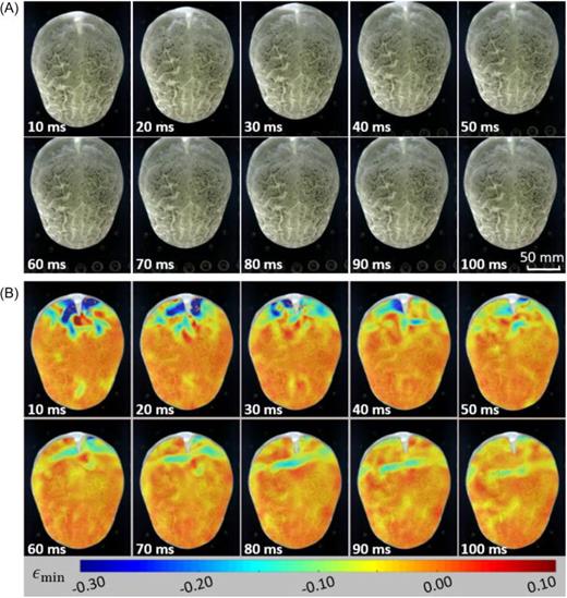 Cavitation causes brain injury | Physics of Fluids | AIP Publishing