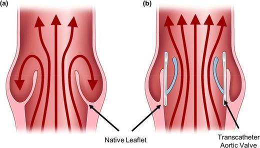 Sinus hemodynamics after transcatheter aortic valve implantation ...