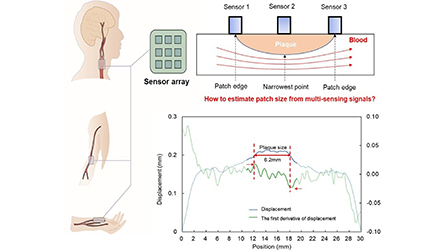 Biomechanical mechanism of noninvasive plaque detection based on multi ...