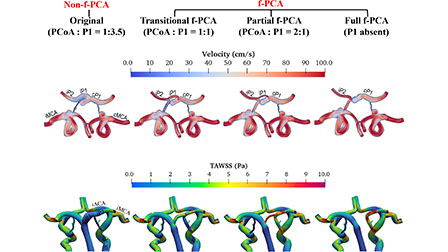 Assessing the impact of fetal-type posterior cerebral artery variations ...