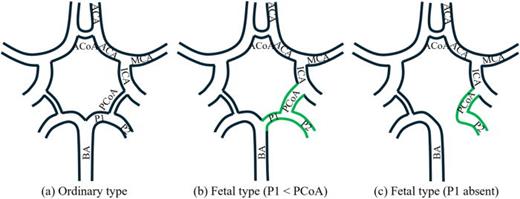 Assessing the impact of fetal-type posterior cerebral artery variations on cerebral hemodynamics ...