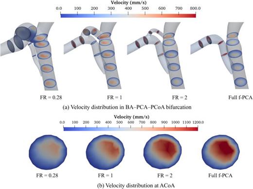 Assessing the impact of fetal-type posterior cerebral artery variations ...