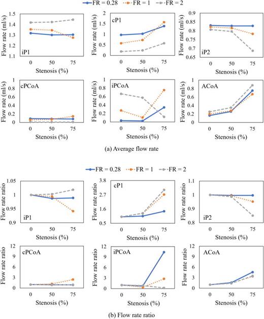 Assessing the impact of fetal-type posterior cerebral artery variations ...