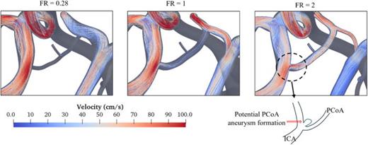 Assessing the impact of fetal-type posterior cerebral artery variations ...