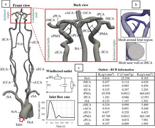 Assessing the impact of fetal-type posterior cerebral artery variations ...