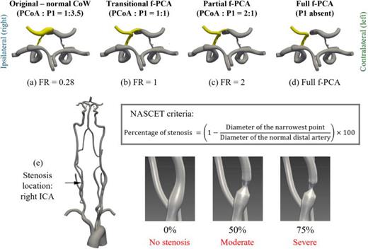 Assessing the impact of fetal-type posterior cerebral artery variations ...