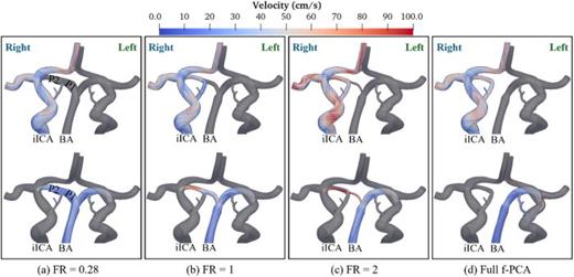 Assessing the impact of fetal-type posterior cerebral artery variations ...