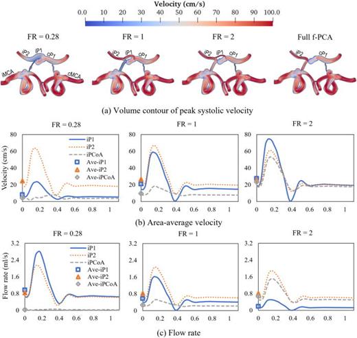 Assessing the impact of fetal-type posterior cerebral artery variations ...